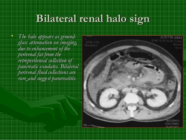 Renal Halo Sign In Acute Pancreatitis