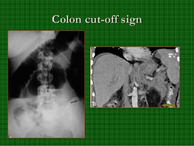 Imaging acute pancreatitis