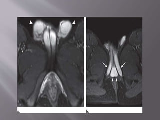 Imaging ambigous genitalia | PPTX