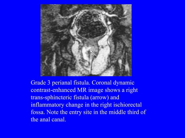 Imaging of Anal Fistulae and perianal abscesses | PPT