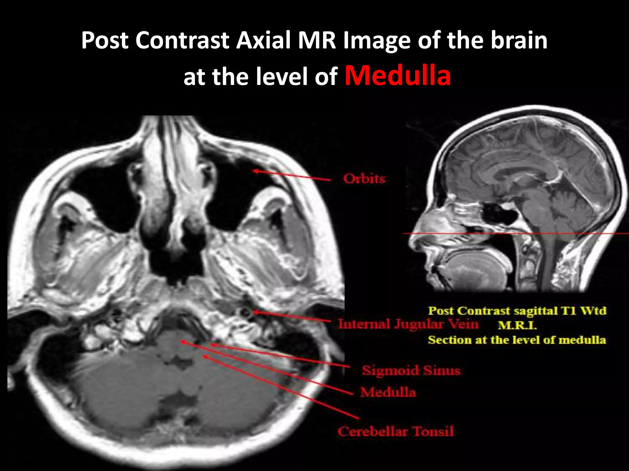 Imaging in neurology - normal anatomy | PPTX