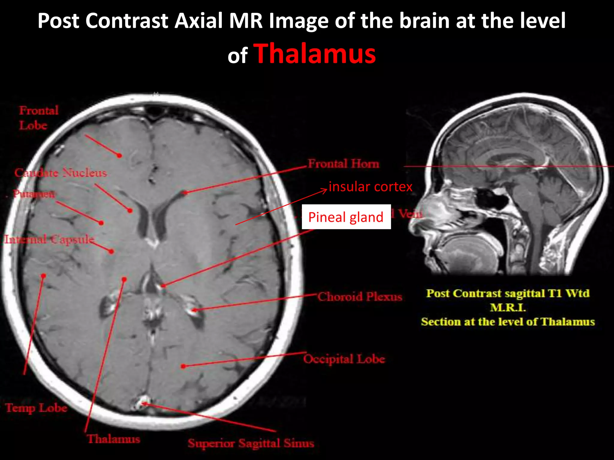 Imaging in neurology - normal anatomy | PPTX
