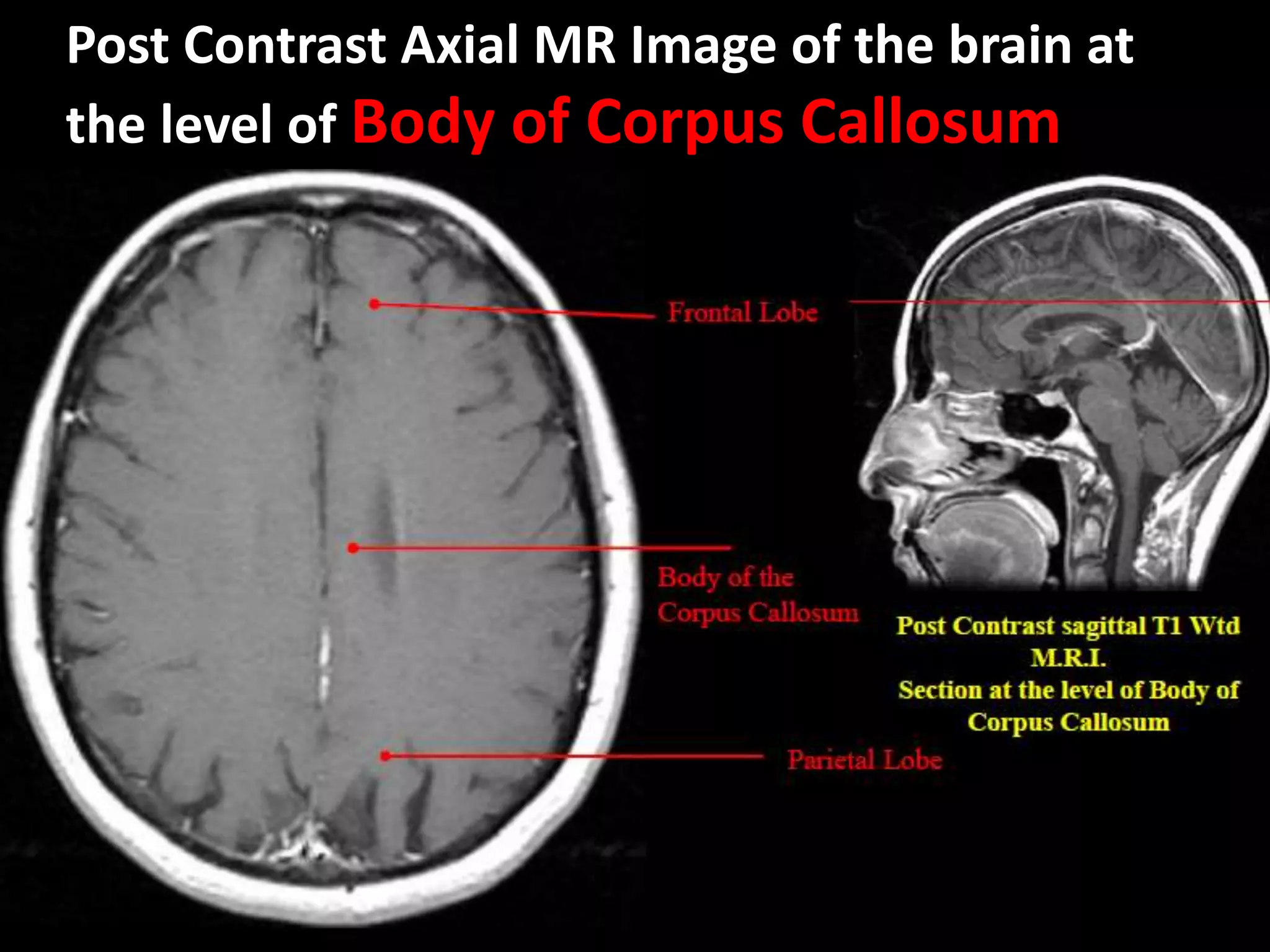 Imaging in neurology - normal anatomy | PPTX