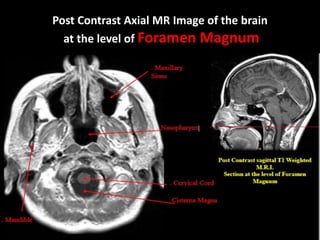 Imaging in neurology - normal anatomy | PPTX