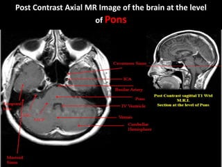 Imaging in neurology - normal anatomy | PPTX