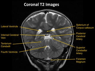 Imaging in neurology - normal anatomy | PPTX