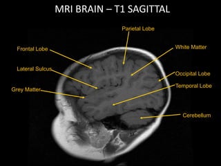 Imaging in neurology - normal anatomy | PPTX