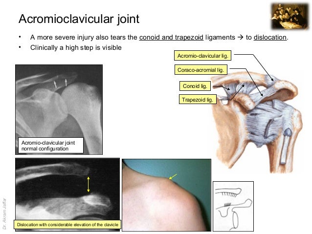 Imaging anatomy dislocation of acromioclavicular joint