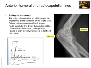 Imaging anatomy dislocation of the elbow | PPT