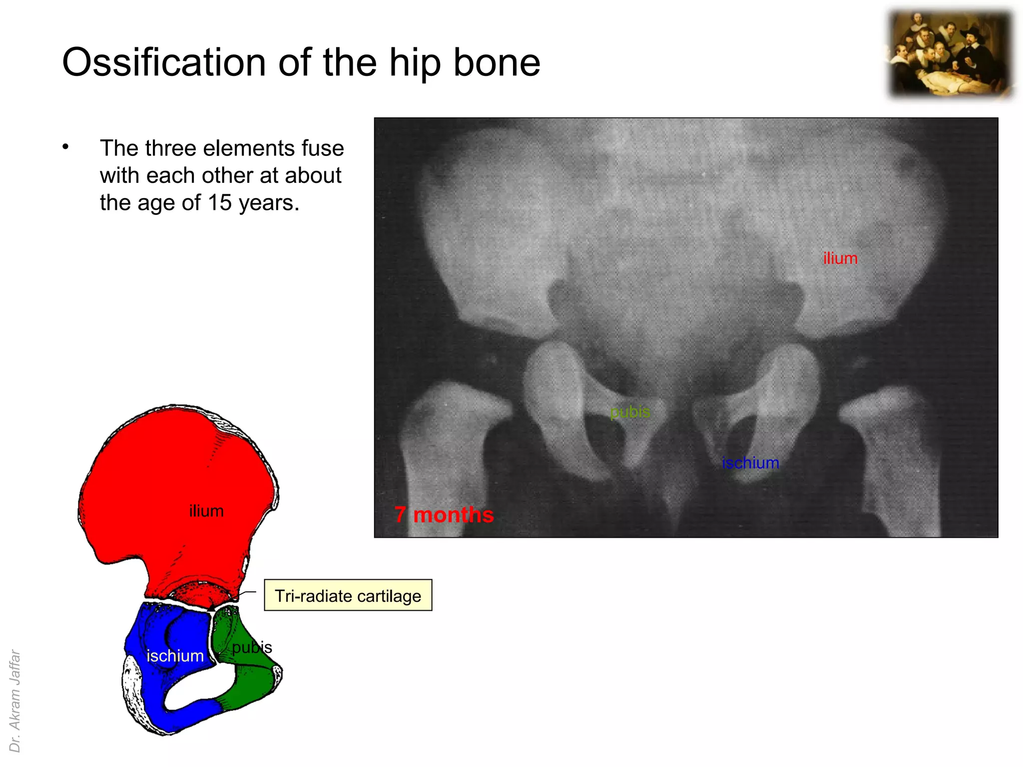 Imaging anatomy dislocation of the hip joint | PPT