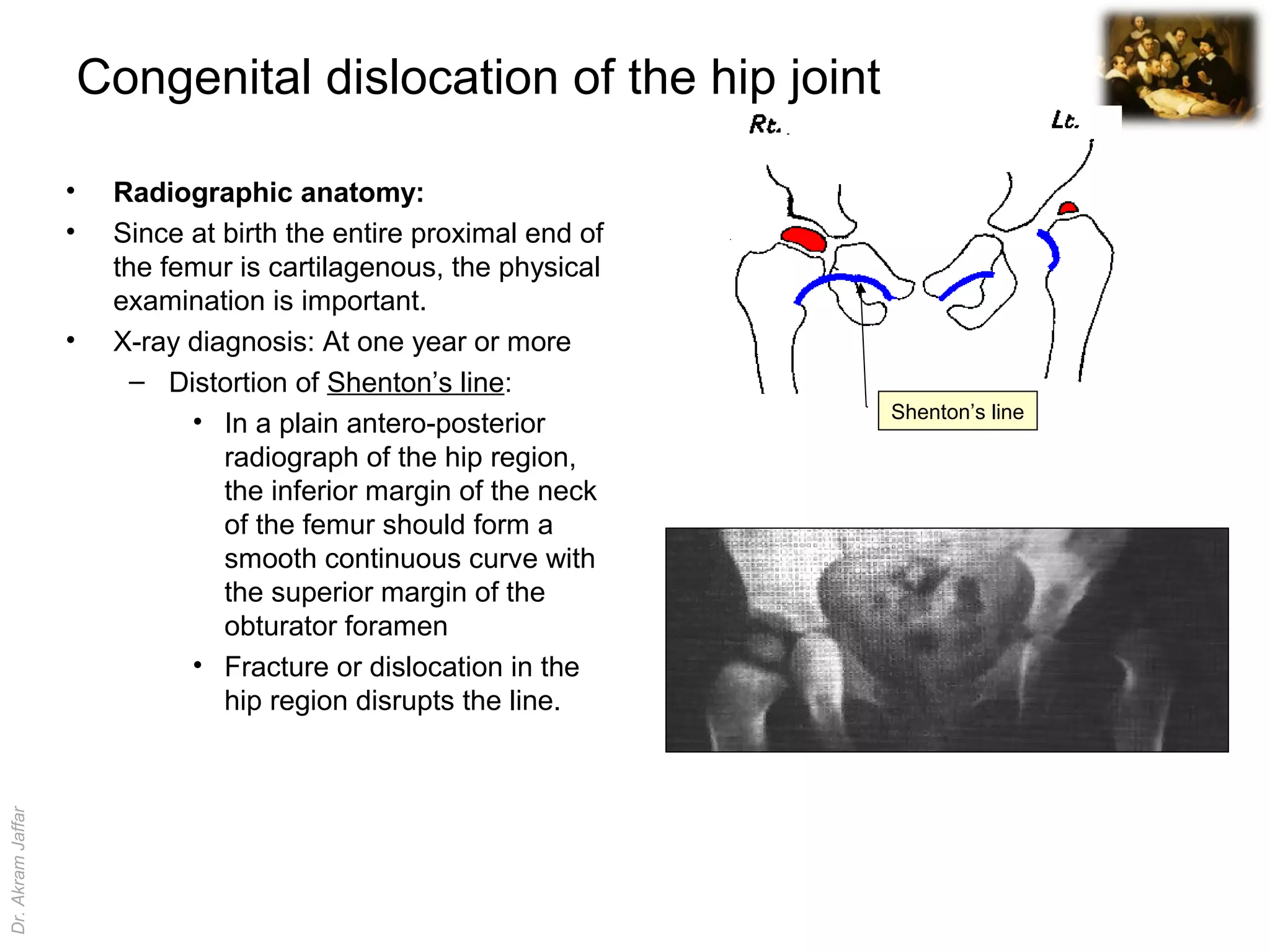 Imaging anatomy dislocation of the hip joint | PPT