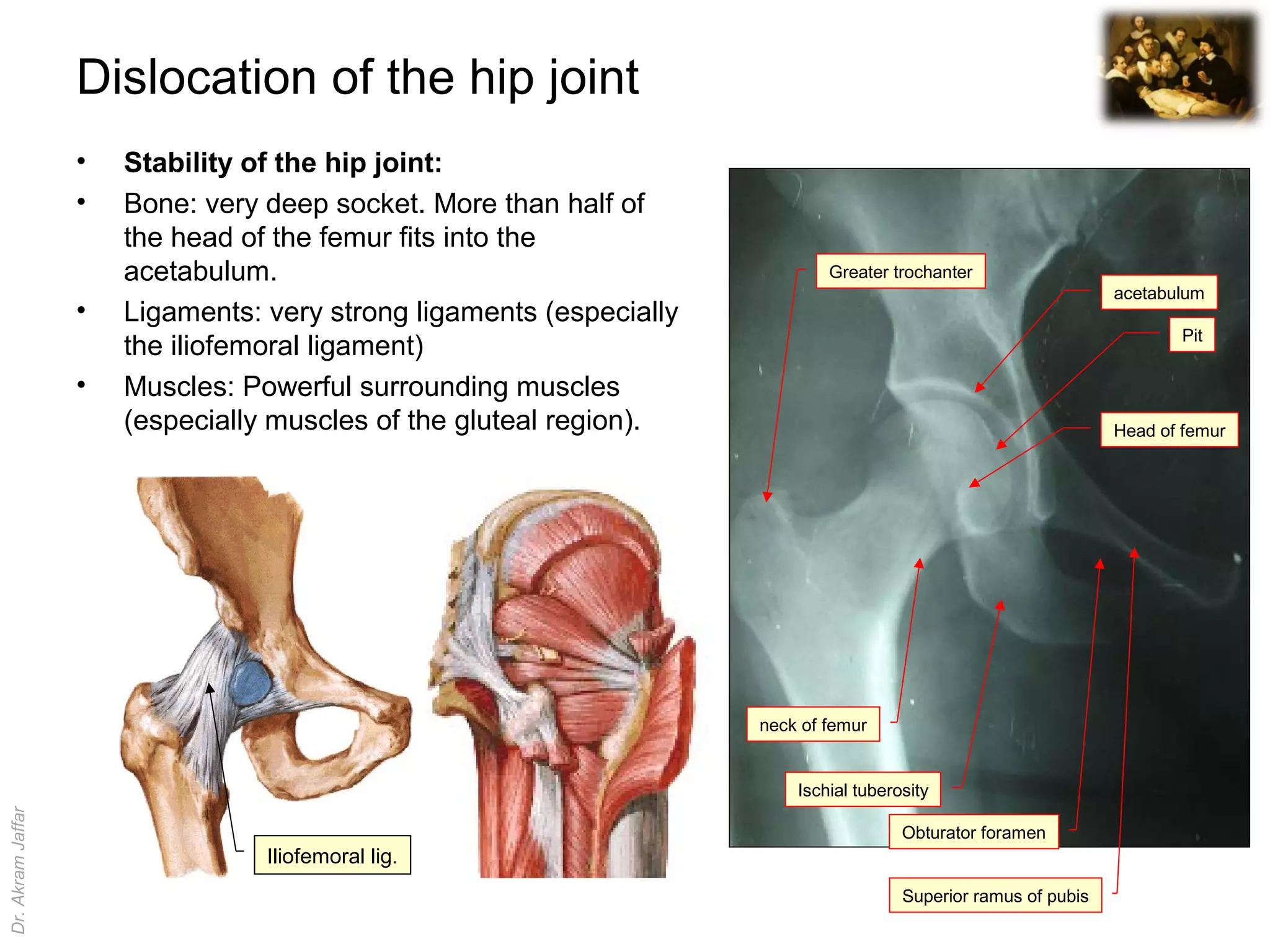 Imaging anatomy dislocation of the hip joint | PPT