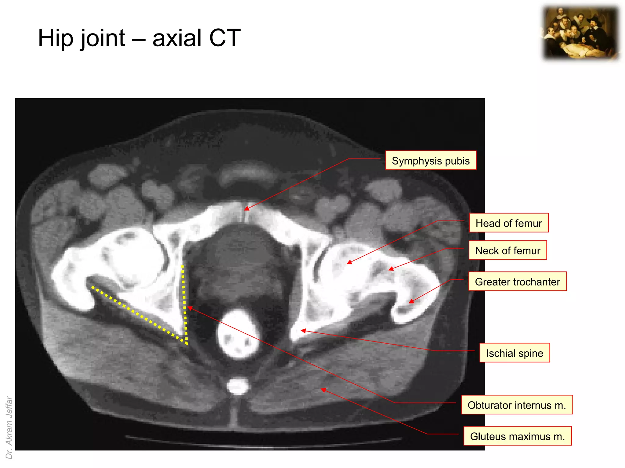 Imaging anatomy dislocation of the hip joint | PPT