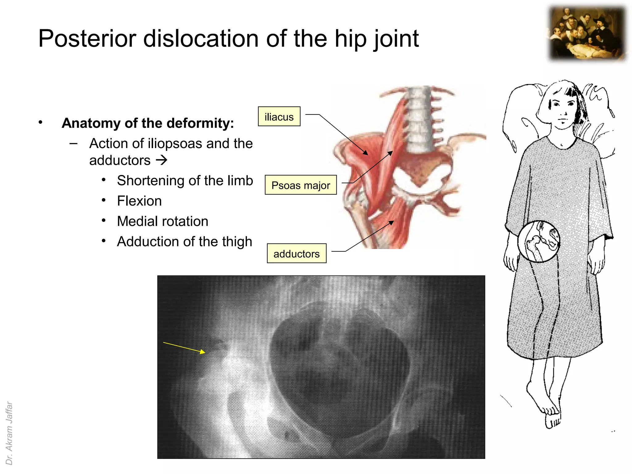 Imaging anatomy dislocation of the hip joint | PPT