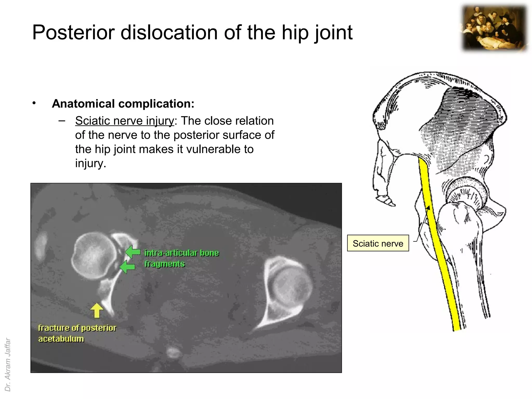 Imaging anatomy dislocation of the hip joint | PPT
