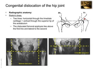 Imaging anatomy dislocation of the hip joint | PPT