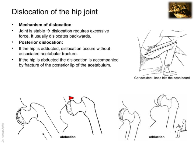 Imaging anatomy dislocation of the hip joint | PPT | Death, Injury, or ...