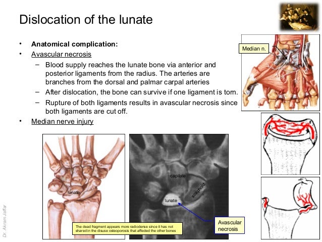 Imaging anatomy dislocation of the lunate