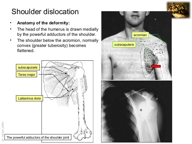 Imaging anatomy dislocation of the shoulder