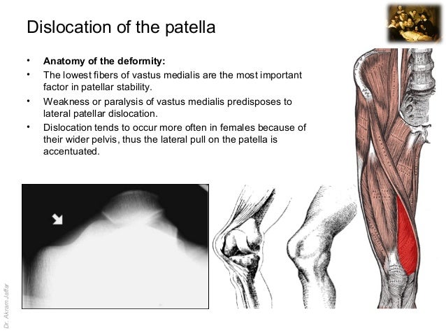 Imaging anatomy fracture and disloaction of the patella