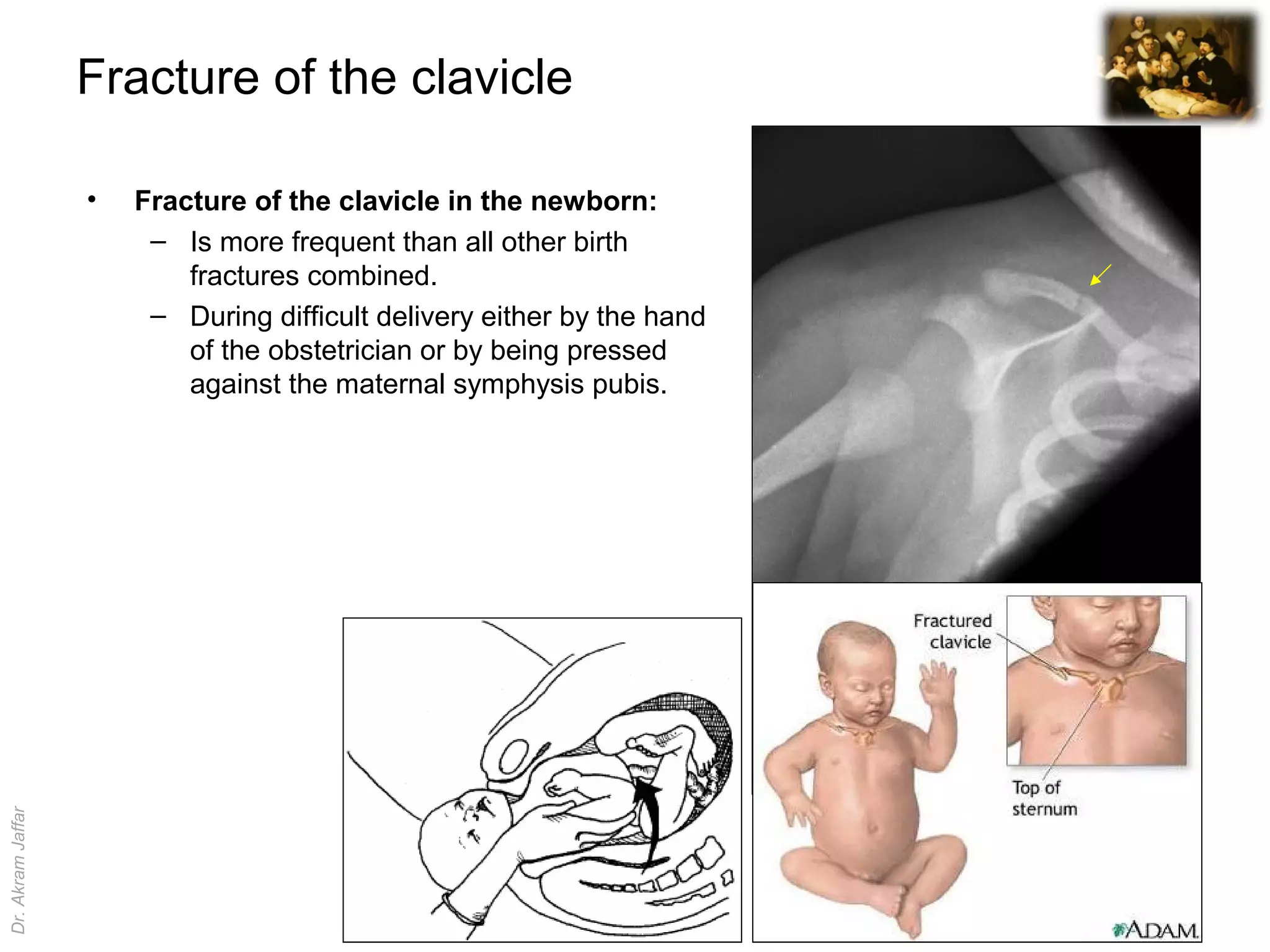 Imaging anatomy fracture of the clavicle | PPT
