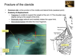 Imaging anatomy fracture of the clavicle | PPT