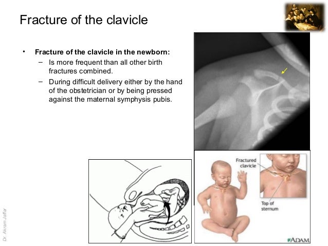 Imaging anatomy fracture of the clavicle