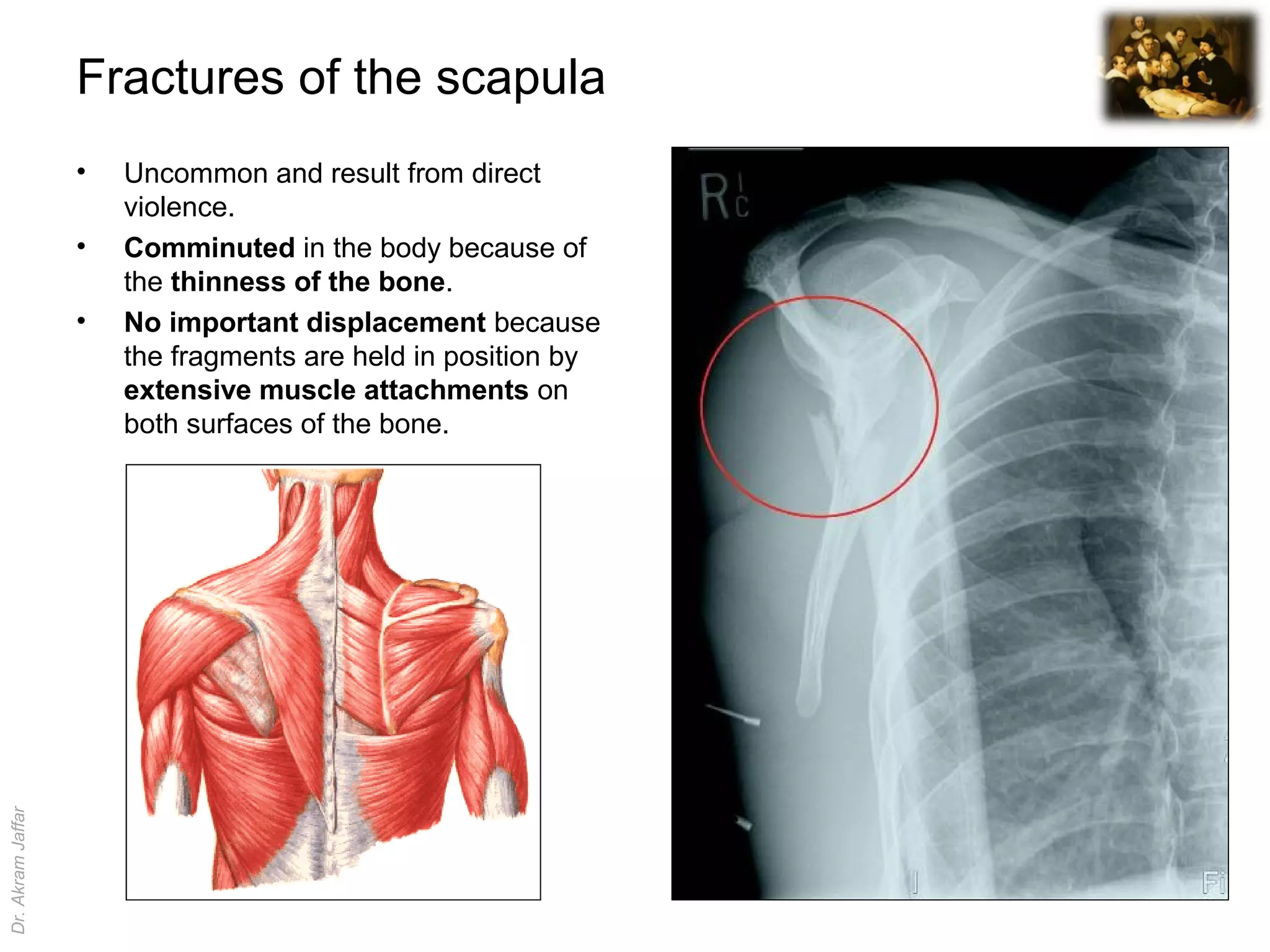 Imaging anatomy fracture of the scapula | PPT