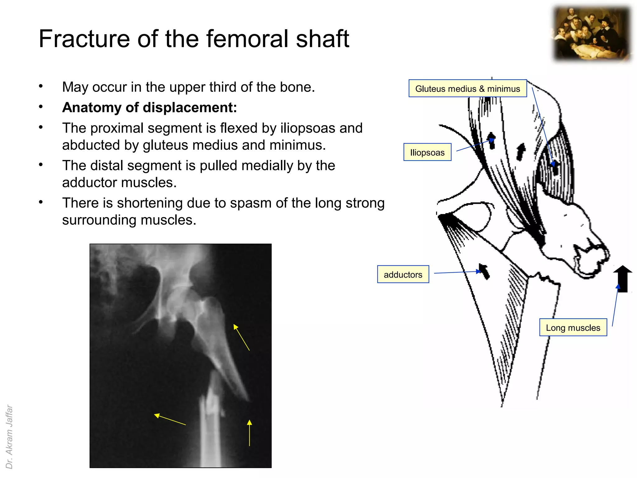 Imaging anatomy fractures of the femur | PPT