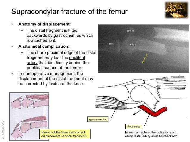 Femur Fracture Anatomy