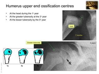 Imaging anatomy fractures of the humerus | PPT