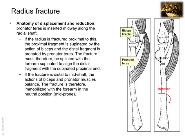 Imaging anatomy fractures of the radius | PPT | Death, Injury, or ...