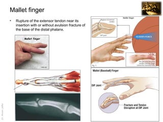 Imaging anatomy mallet finger | PPT