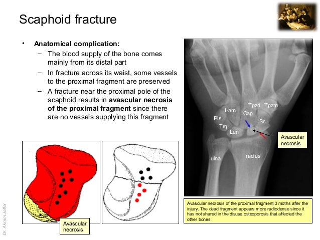 Imaging anatomy scaphoid fracture