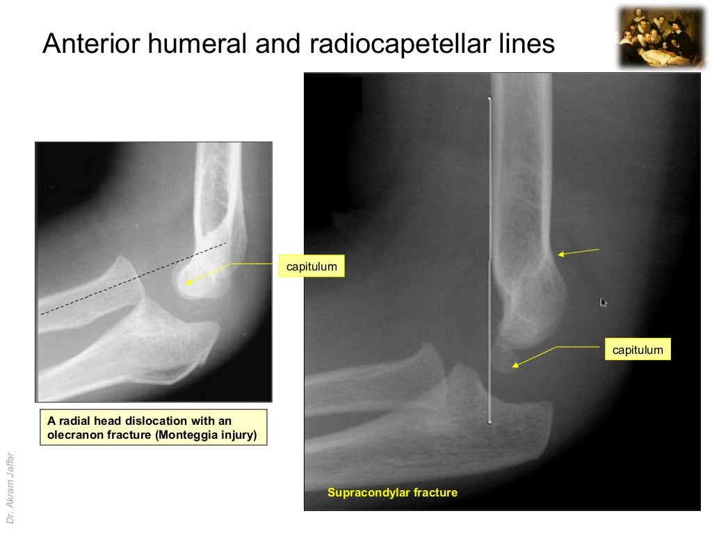 Imaging anatomy subluxation of the head of the radius
