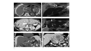 IMAGING ANATOMY OF PERITONEAL SPACES.pptx