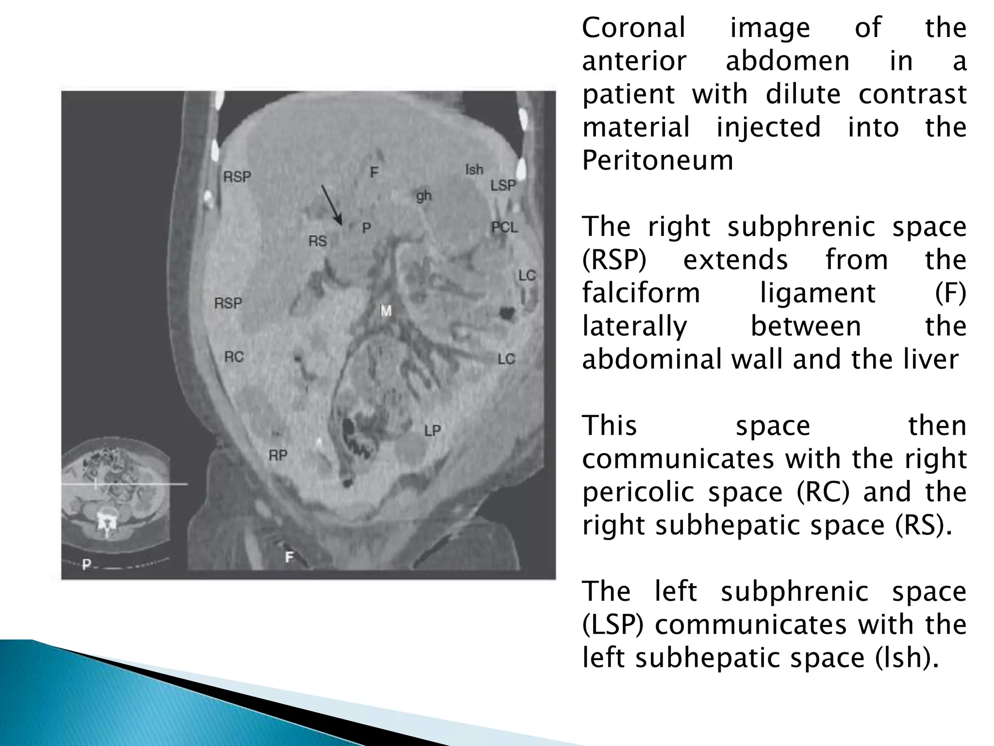 Imaging anatomy of peritoneum | PPTX