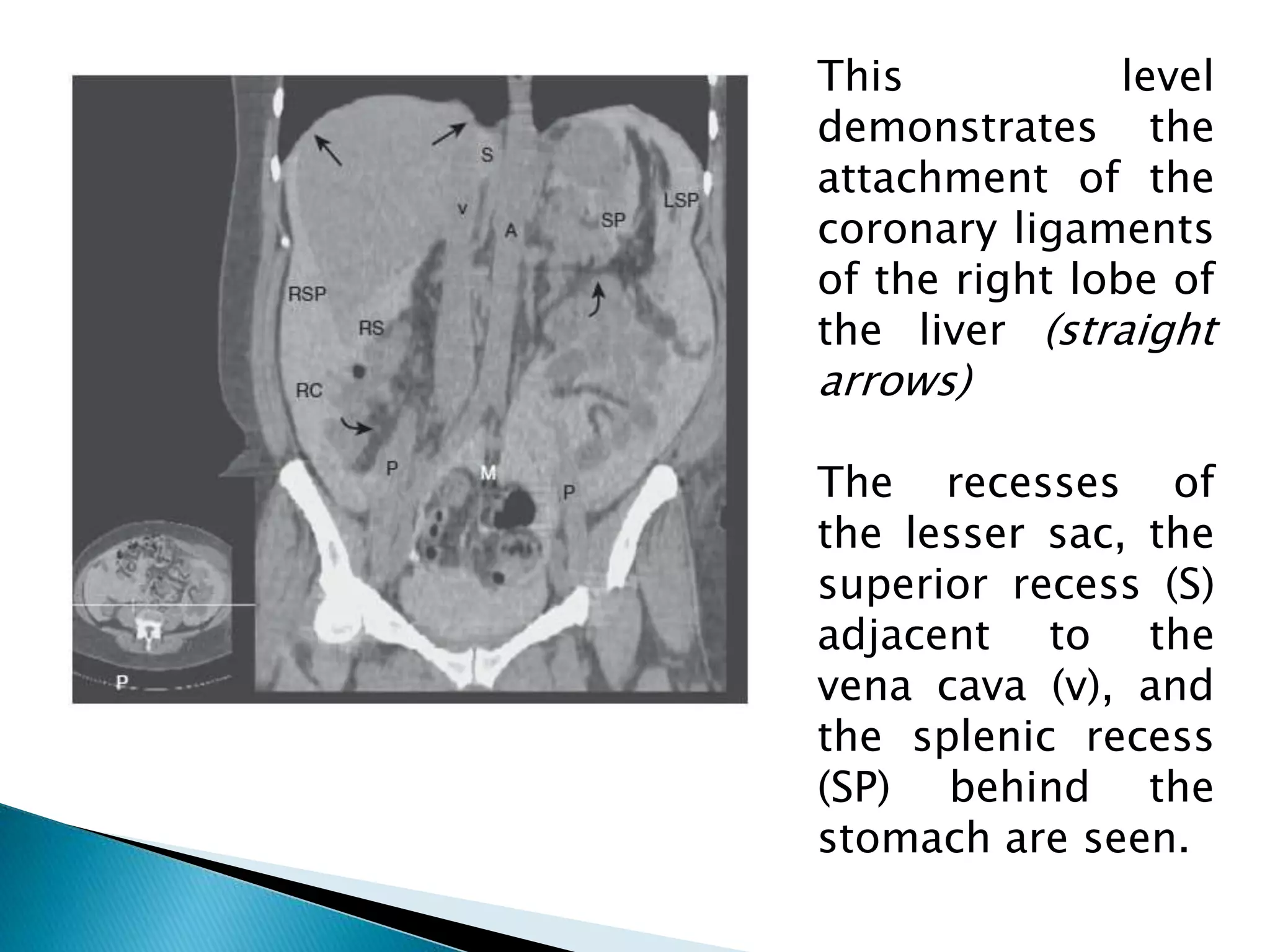 Imaging anatomy of peritoneum | PPTX