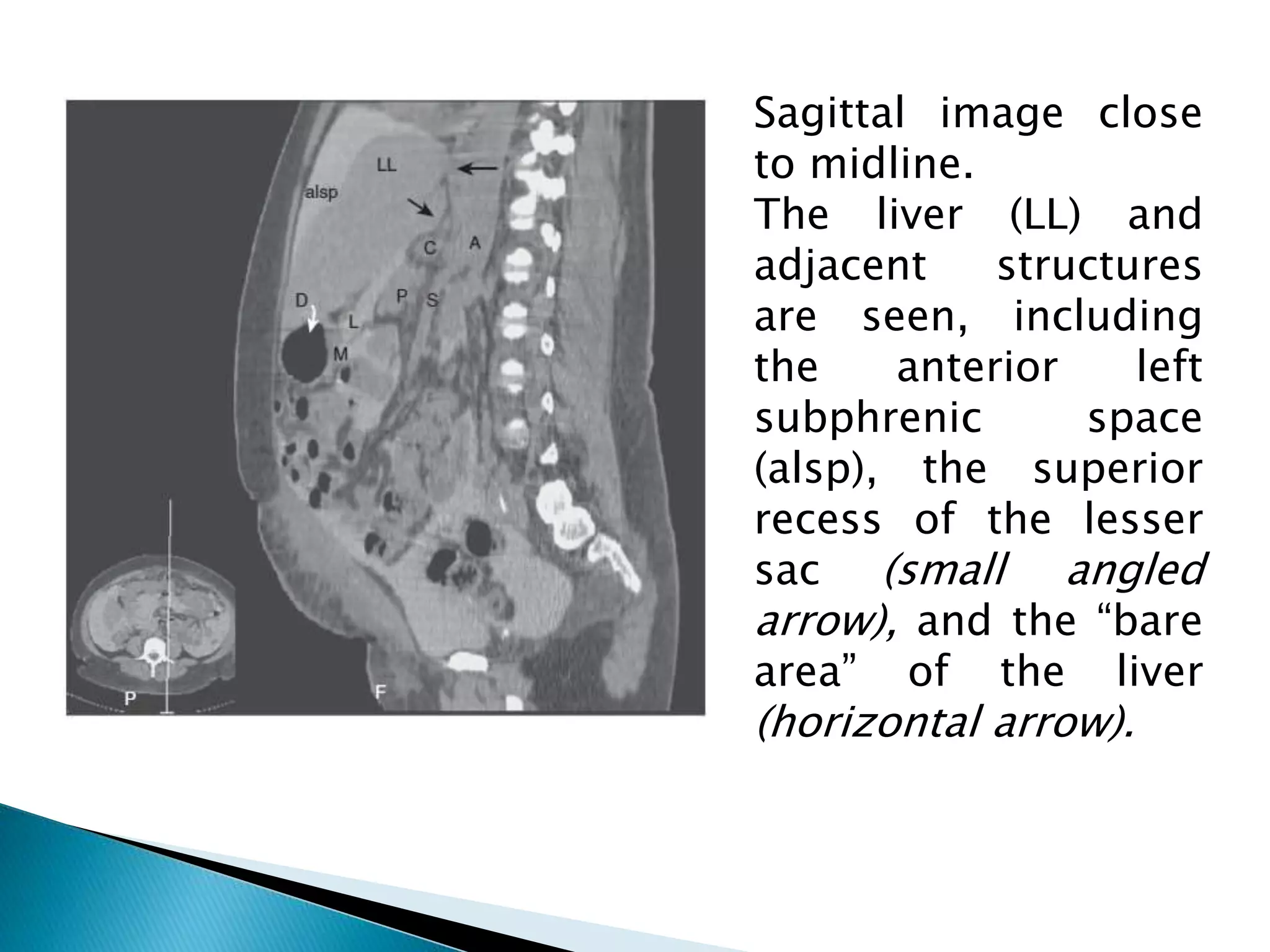 Imaging anatomy of peritoneum | PPTX