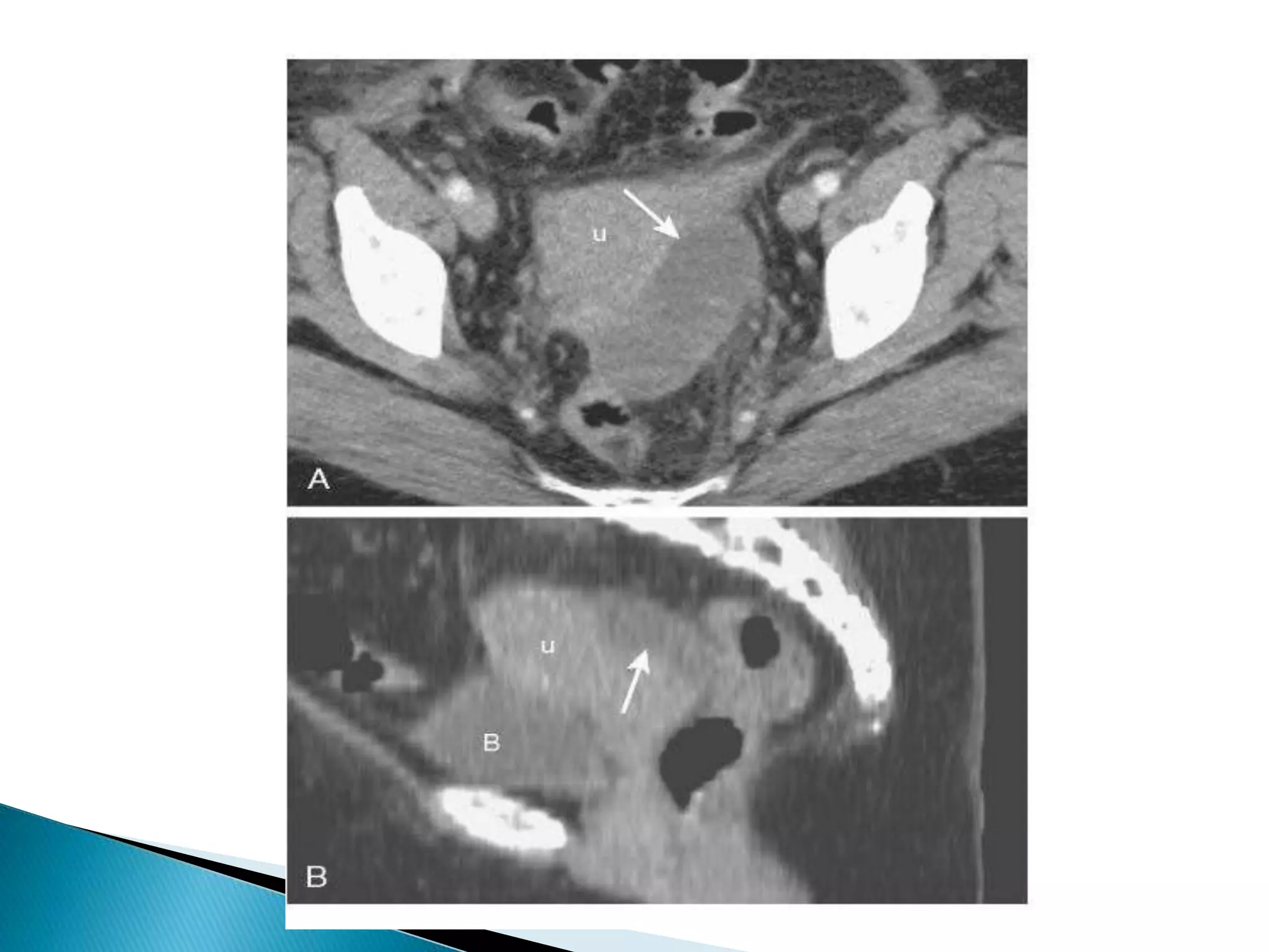 Imaging anatomy of peritoneum | PPTX