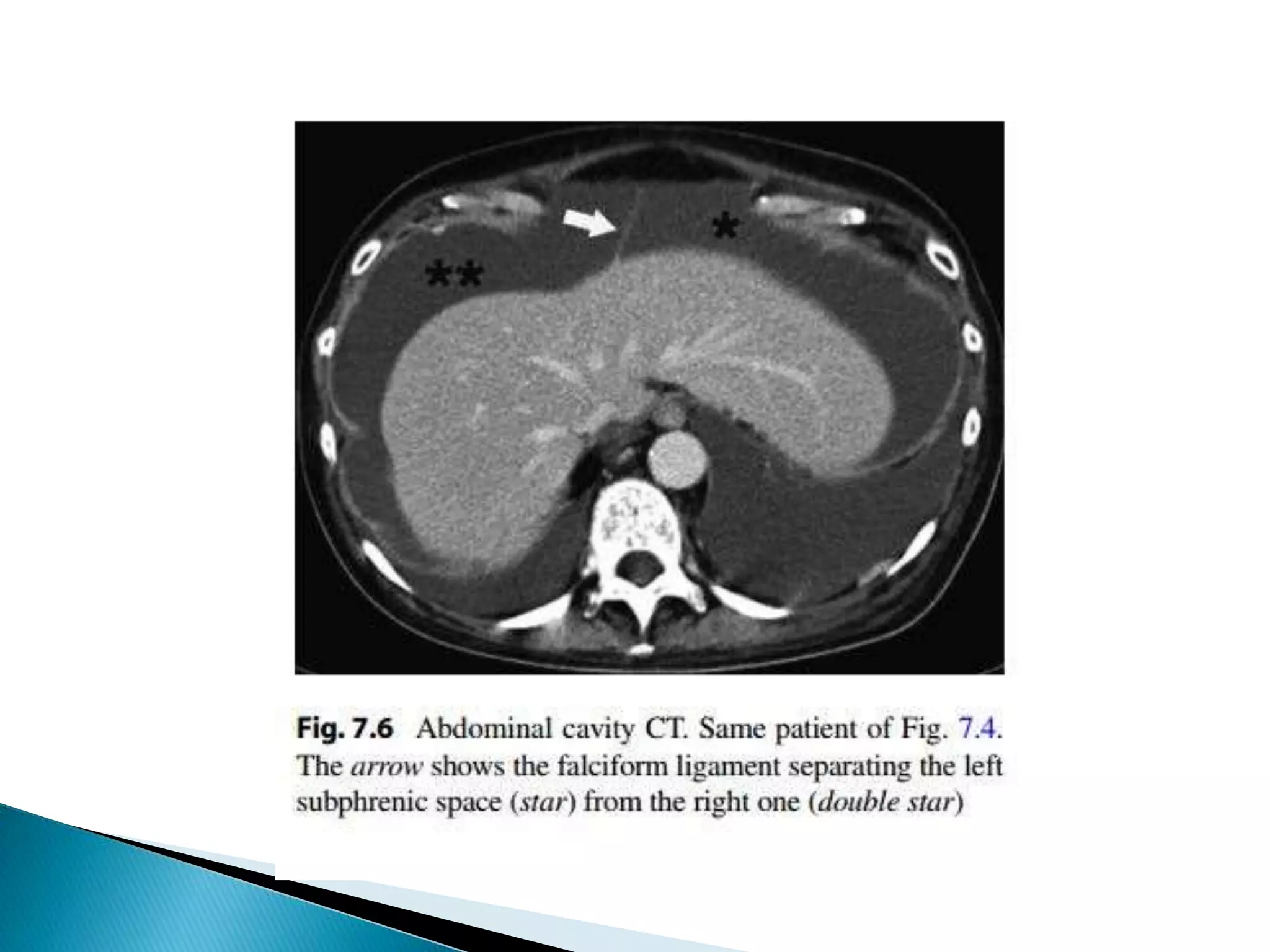 Imaging anatomy of peritoneum | PPTX