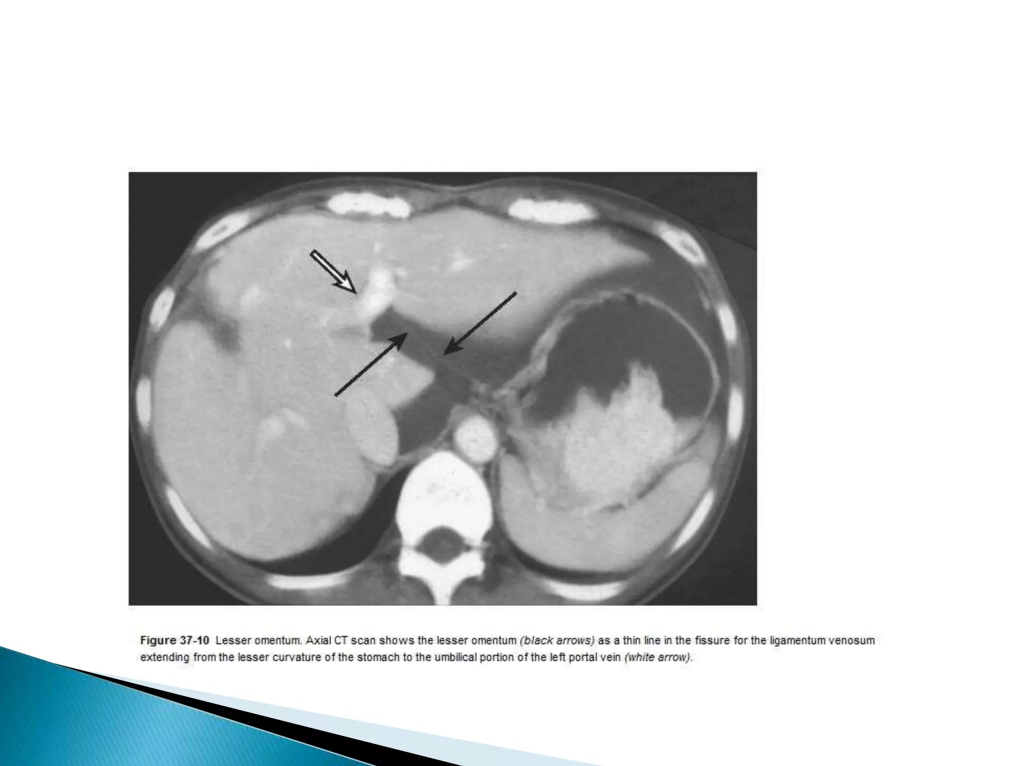 Imaging anatomy of peritoneum | PPTX