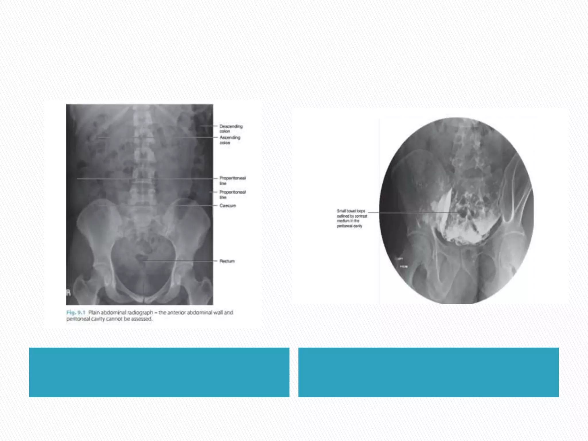 Imaging anatomy of peritoneum | PPTX