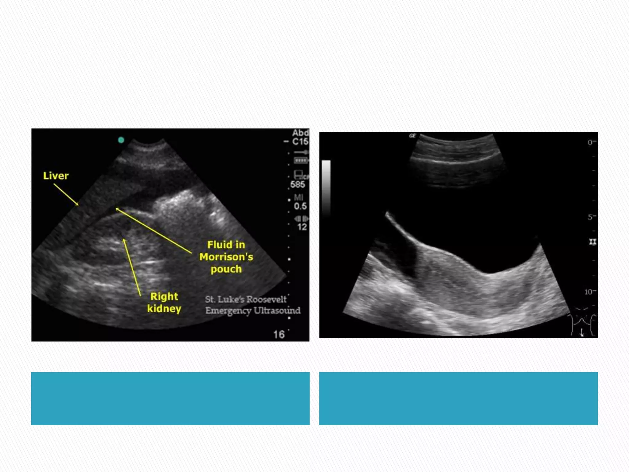 Imaging anatomy of peritoneum | PPTX