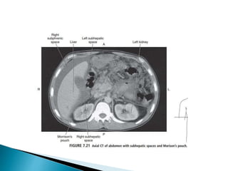 Imaging anatomy of peritoneum | PPTX