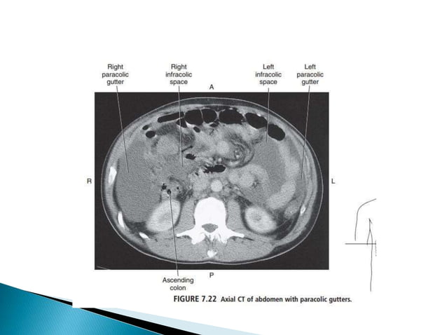 Imaging anatomy of peritoneum | PPTX | Death, Injury, or Military ...
