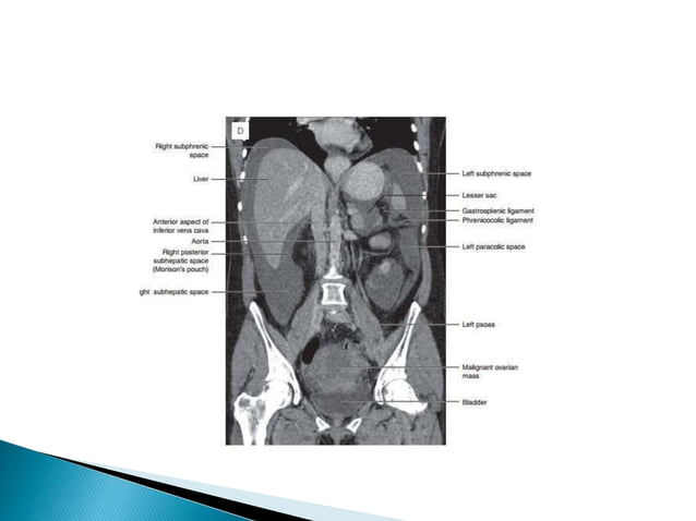 Imaging anatomy of peritoneum | PPTX | Death, Injury, or Military ...