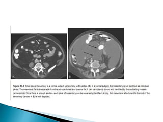 Imaging anatomy of peritoneum | PPTX