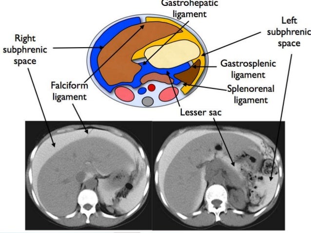 Imaging anatomy of peritoneum