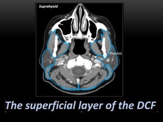 IMAGING ANATOMY OF SUPRAHYOID NECK SPACES copy.pptx
